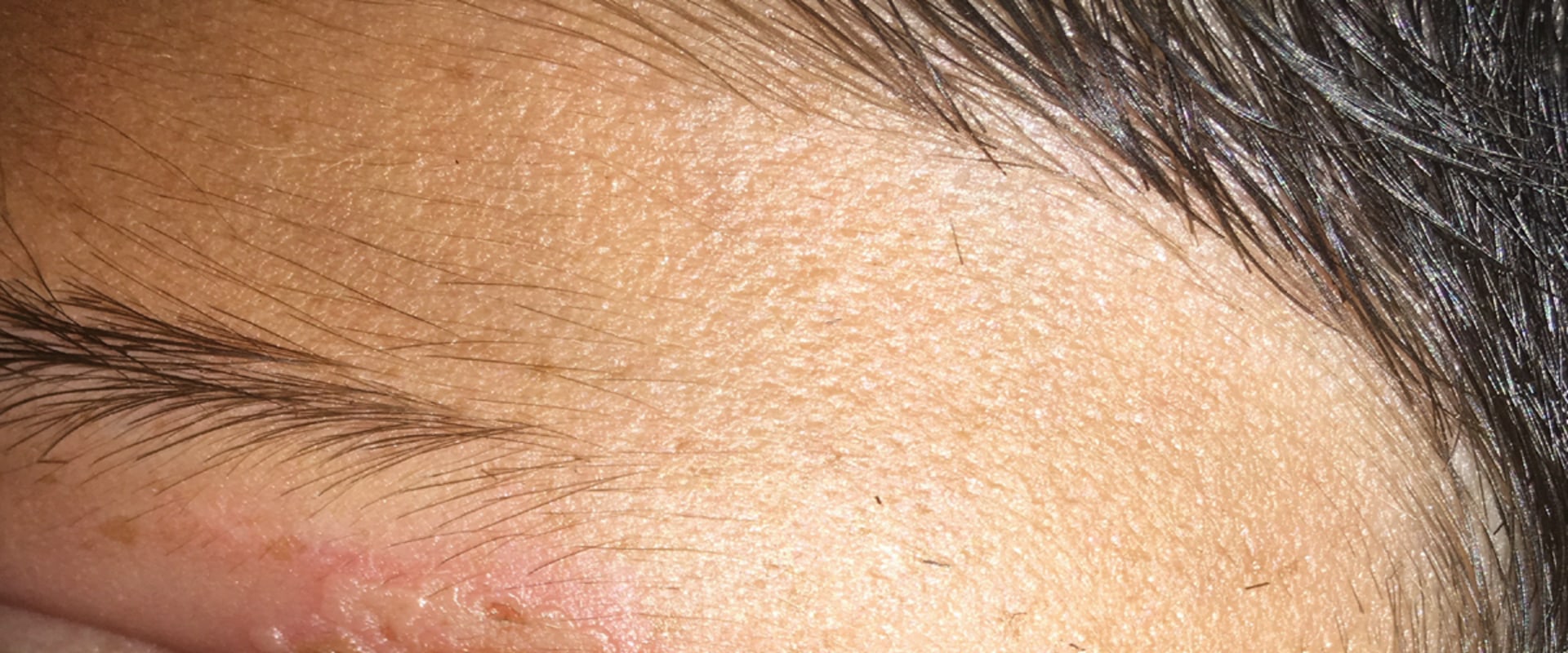 Famciclovir: An Overview of a Common Herpes Treatment and Solution